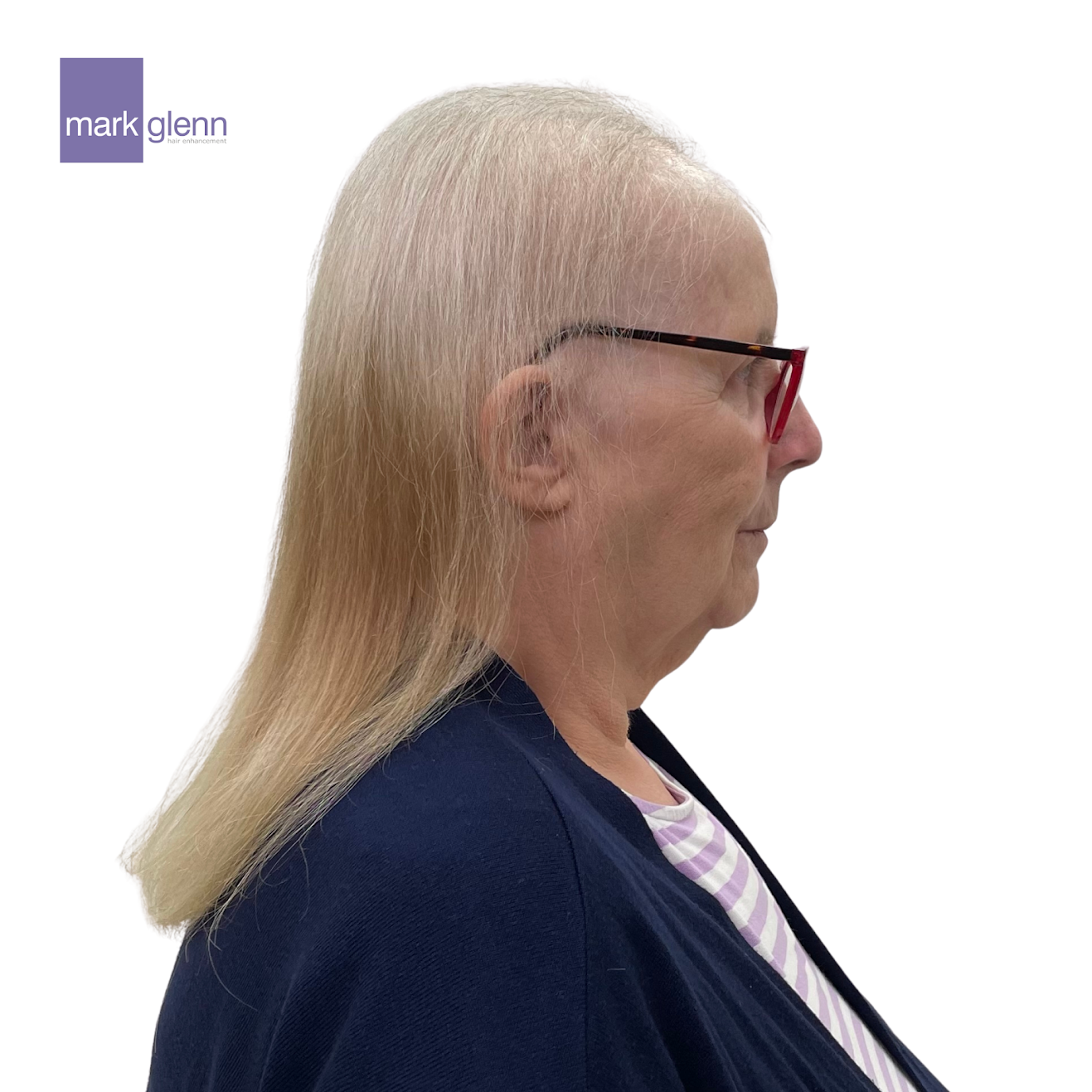 Hl115 Androgenetic Alopecia Or Female Pattern Hair Loss Solution