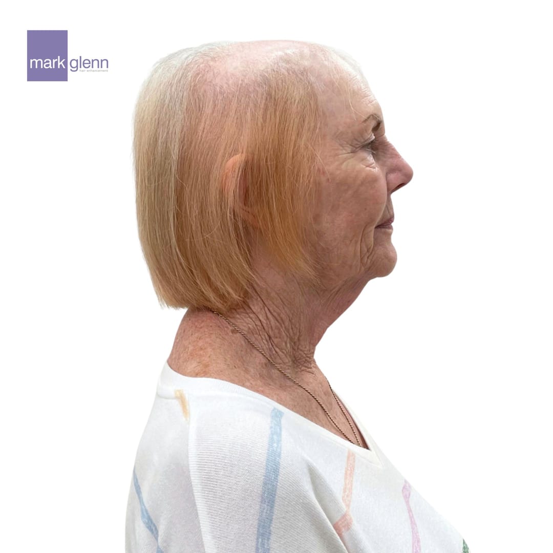 Hl119 Female Pattern Hair Loss Androgenetic Alopecia Magical