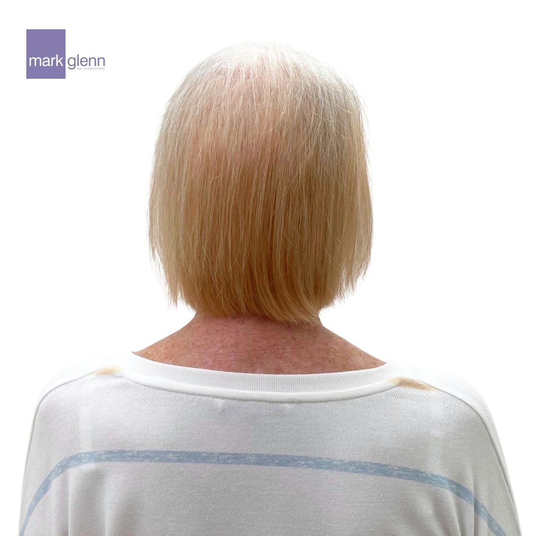 Hl119 Female Pattern Hair Loss Androgenetic Alopecia Magical